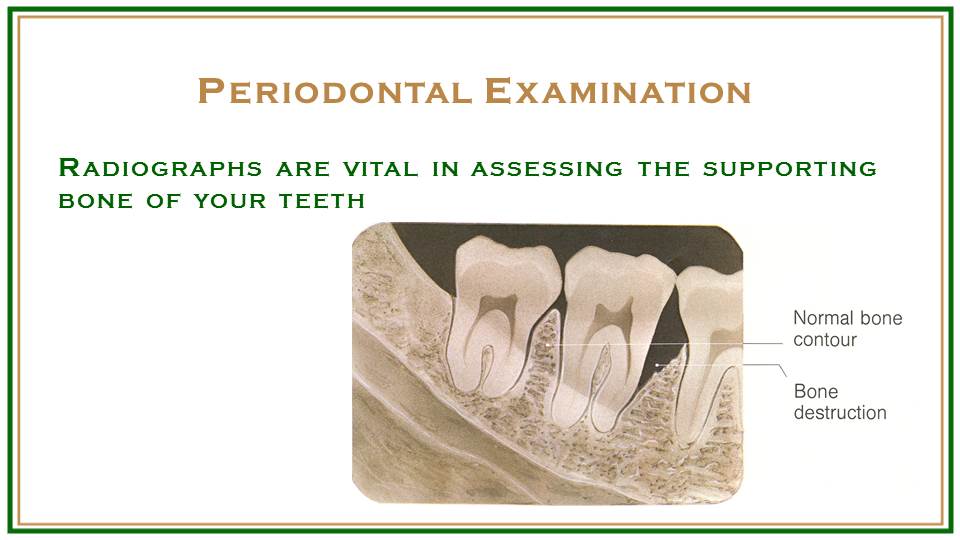 Gum Disease (Periodontal Disease) | Dr. Marvin B. Budd | Periodontist ...