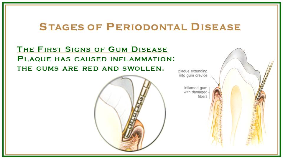 Gum Disease (Periodontal Disease) | Dr. Marvin B. Budd | Periodontist ...