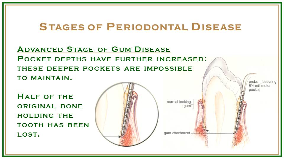 Gum Disease (Periodontal Disease) | Dr. Marvin B. Budd | Periodontist ...